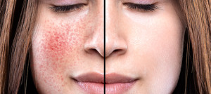 Rosacea Types, Causes, and Treatments – Medlinks